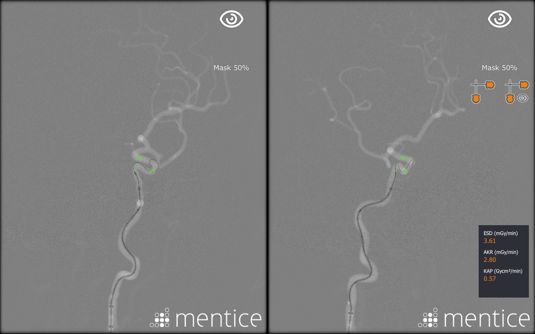 Neurovascular Essentials Software